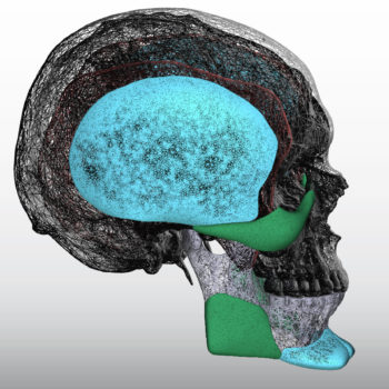 Plastic Surgery Case Study - Custom Temporal Implants for a Head ...