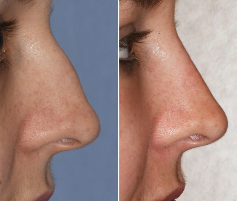 Plastic Surgery Case Study - Closed Approach for Female Hump Reduction ...