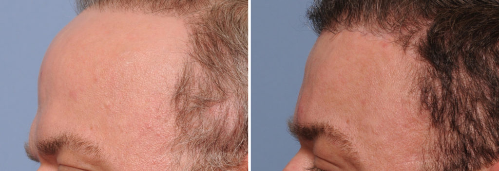 Current Techniques in Forehead Reduction - Explore Plastic Surgery
