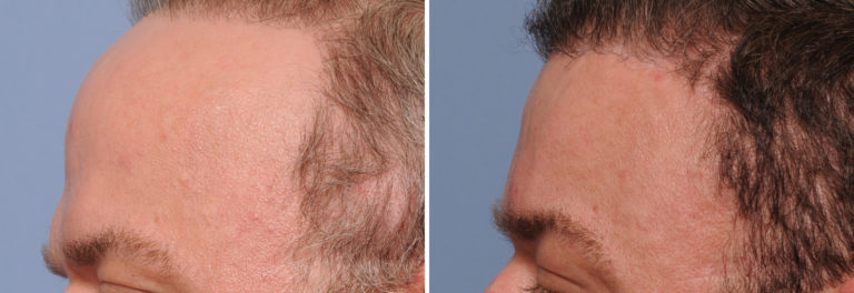 Current Techniques in Forehead Reduction - Explore Plastic Surgery