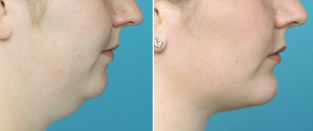 The Aesthetic Effects of the Bony Genioplasty - Horizontal Augmentation ...