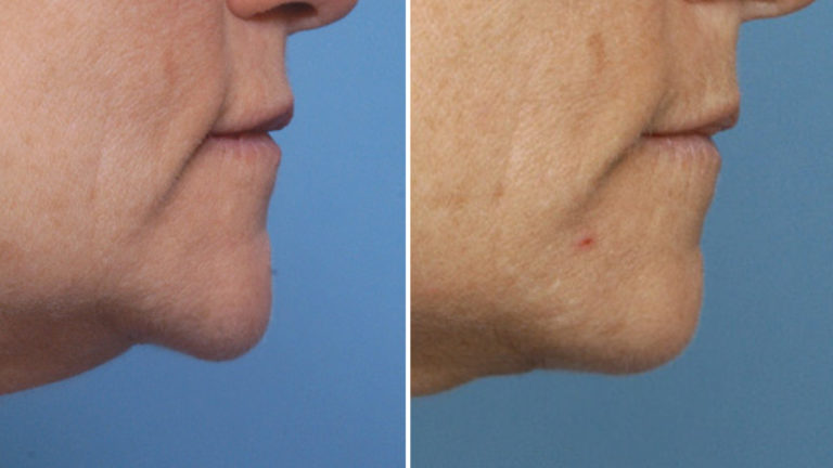 Current Concepts in Chin Ptosis Correction - Explore Plastic Surgery