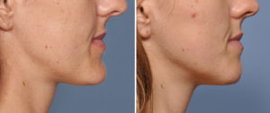 Current Concepts in Horizontal and Vertical Chin Reduction - Explore ...