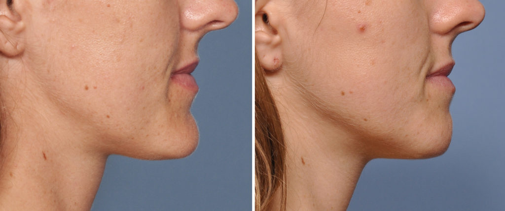 Current Concepts in Horizontal and Vertical Chin Reduction - Explore Plastic Surgery