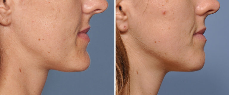 Current Concepts in Horizontal and Vertical Chin Reduction - Explore ...