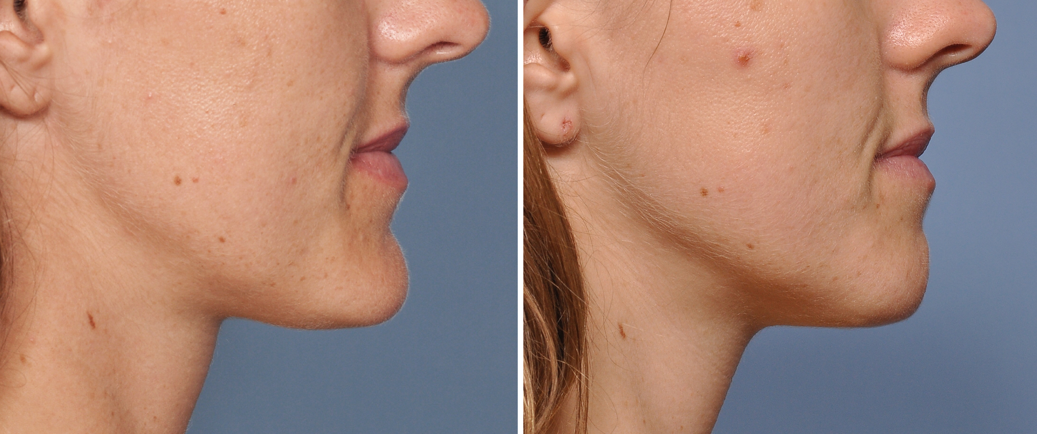 Current Concepts in Horizontal and Vertical Chin Reduction - Explore ...
