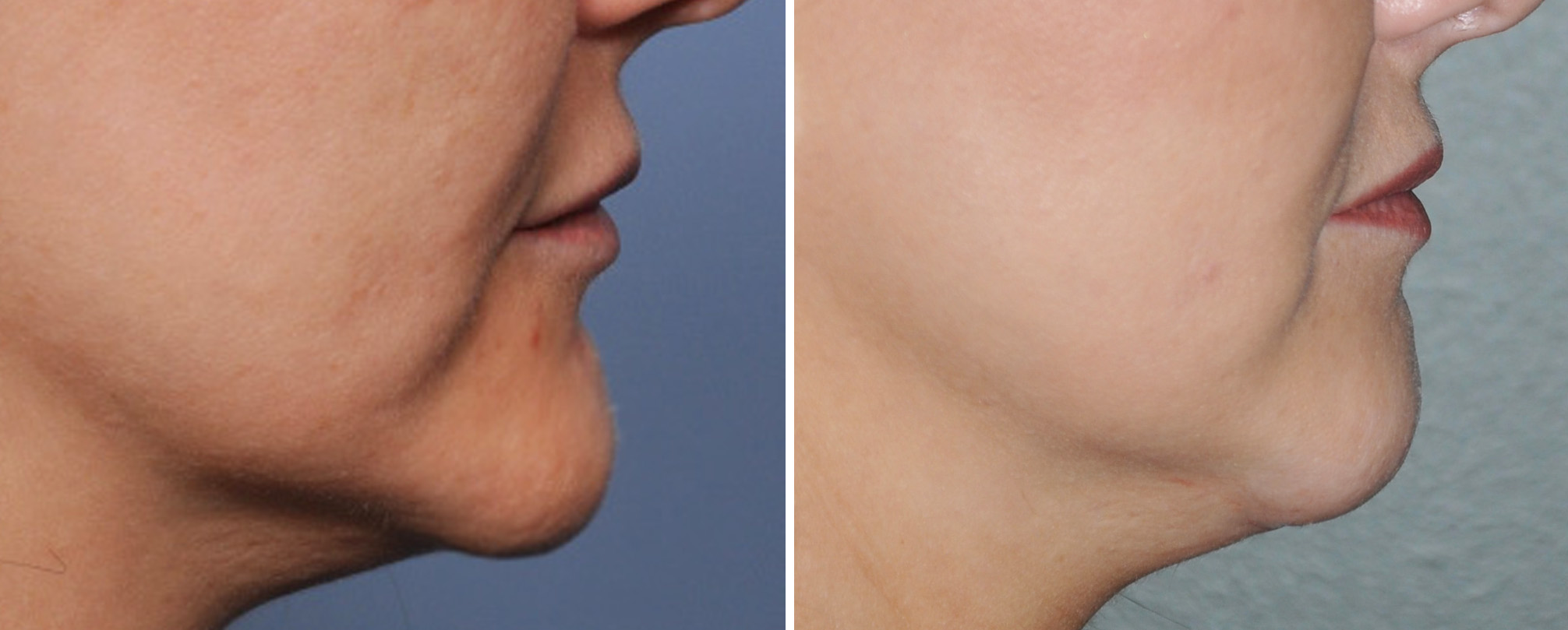 Current Concepts in Horizontal and Vertical Chin Reduction - Explore ...