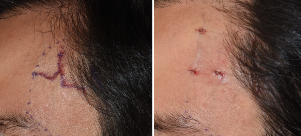 Plastic Surgery Case Study - Anterior and Posterior Temporal Reductions ...