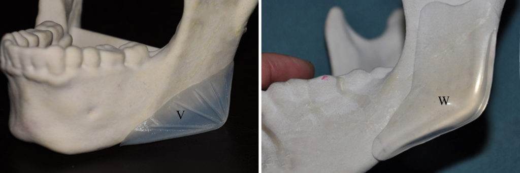 Basic Concepts in Jaw Angle Implant Surgery - II. Implant Selection ...