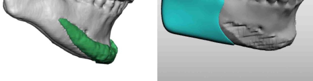 Understanding the Biologic Concept of Bone Imprinting Caused By Facial ...