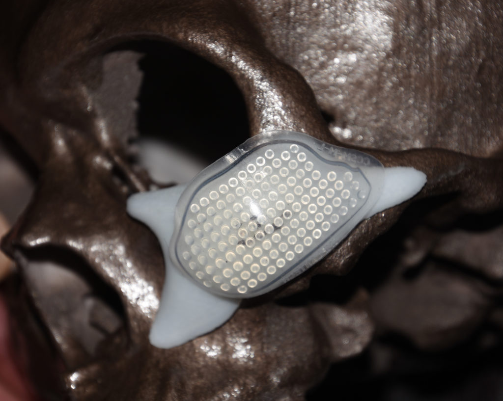 Plastic Surgery Case Study - Custom Cheek Implants Designed Using The ...