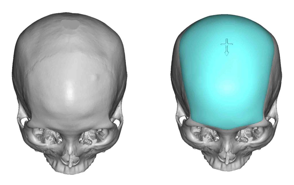 Plastic Surgery Case Study - Custom Forehead-Skull Implant for Female ...