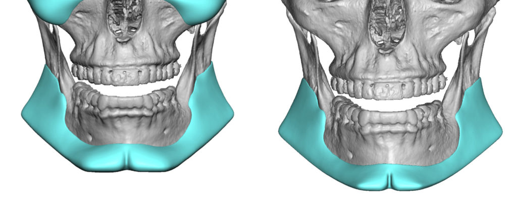The Equilateral Triangle Concept in Custom Jawline Implant Design ...