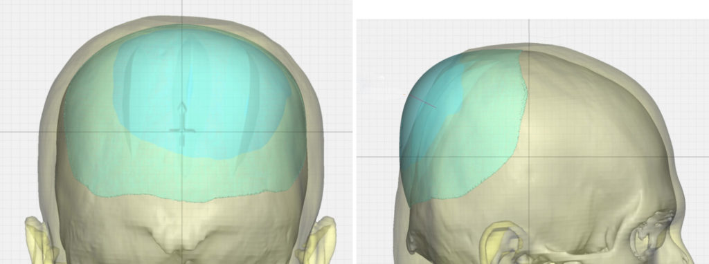 Plastic Surgery Case Study - The Over Corrected Custom Occipital Skull ...