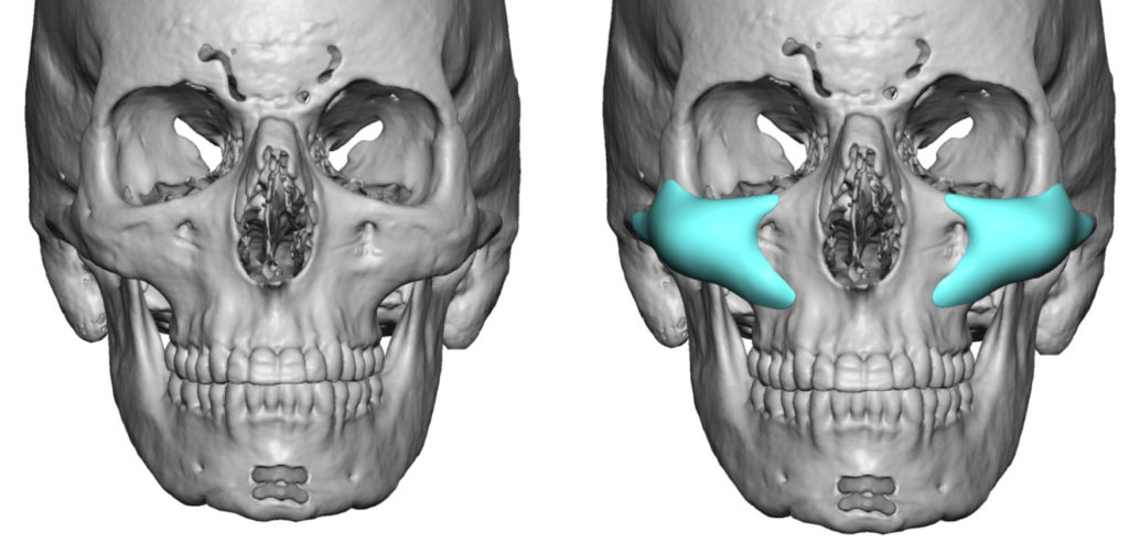 Plastic Surgery Case Study - Custom Cheek Implants Designed Using The ...