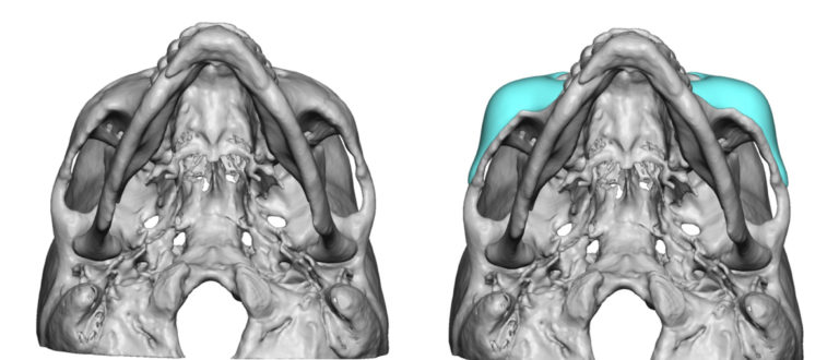 Plastic Surgery Case Study - Custom Cheek Implants Designed Using The ...