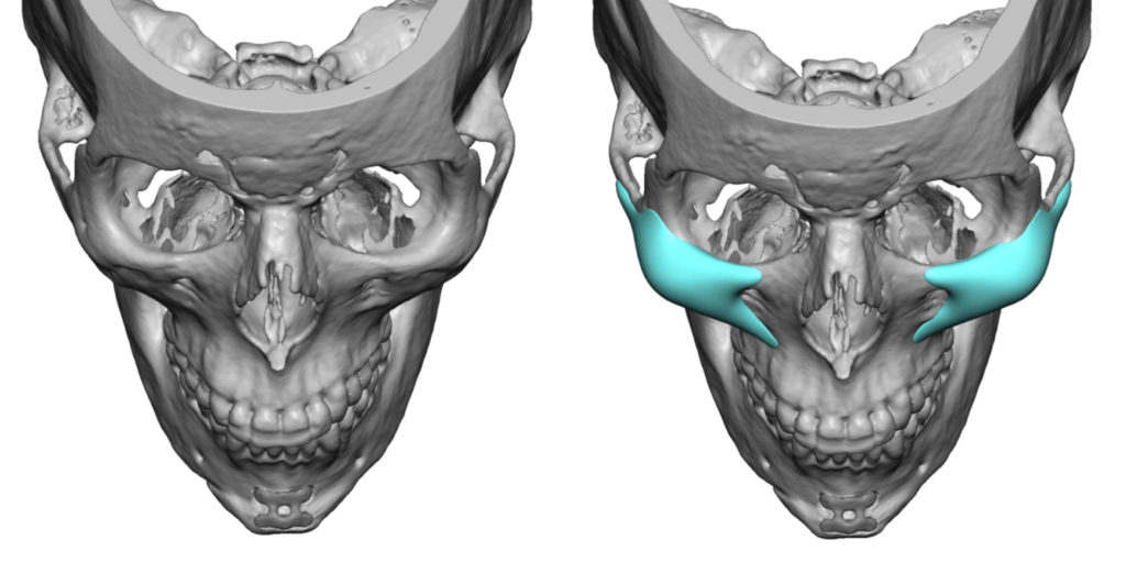 Plastic Surgery Case Study - Custom Cheek Implants Designed Using The ...
