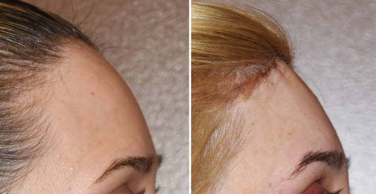 Plastic Surgery Case Study - Total Forehead Reshaping Surgery in a ...