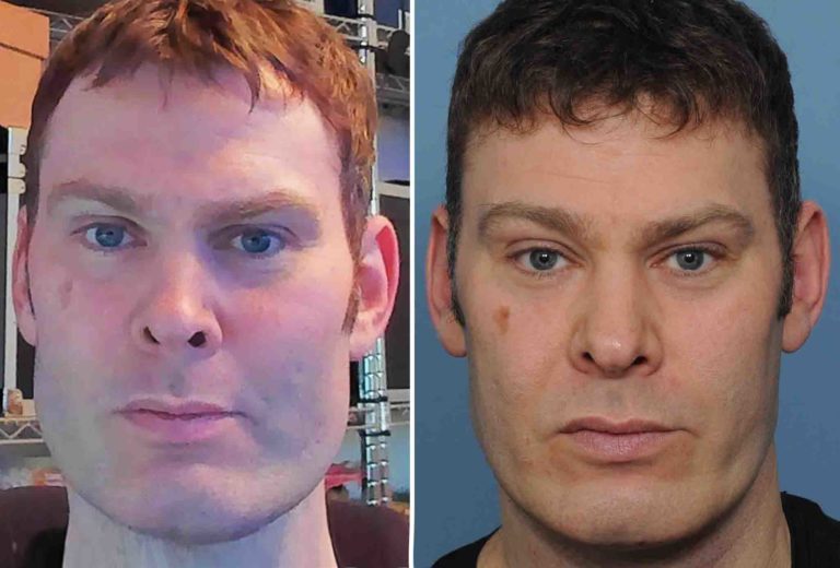 Male Custom Infraorbital-Malar Custom Jawline Imlpant swelling ...