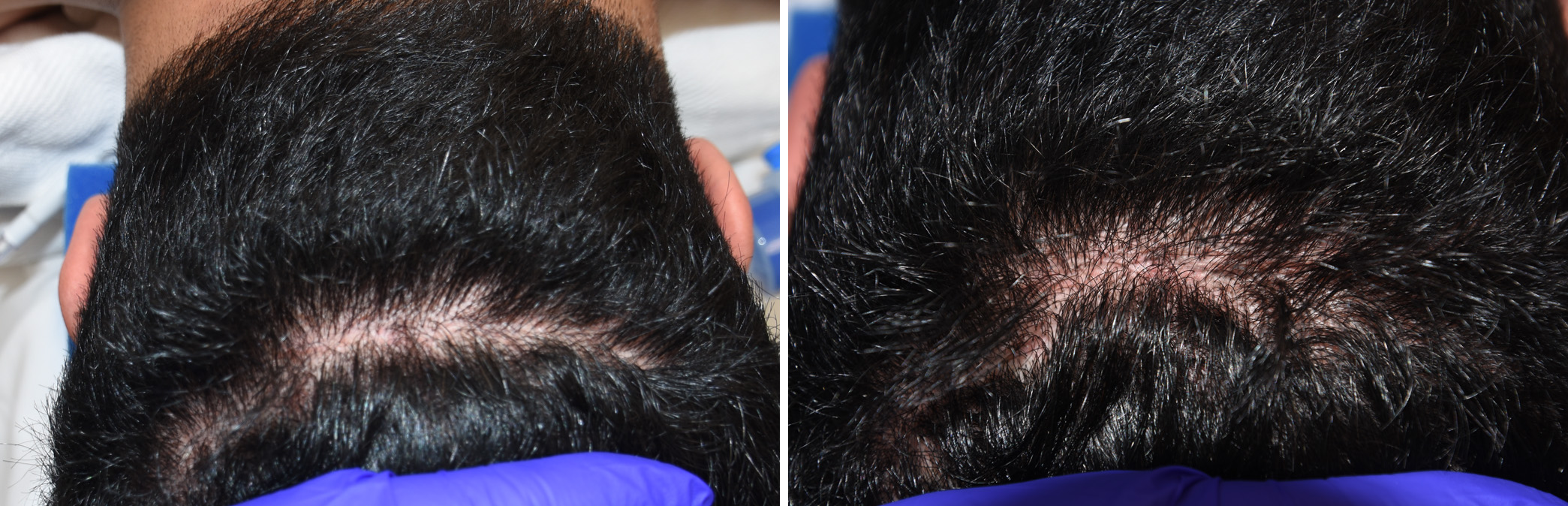Scalp Scar from Custom Occipital Skull Implant Dr Barryt Eppley ...