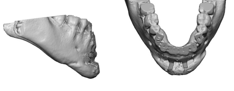 3D CT scan of Sliding Genioplasty Dr Barry Eppley Indianapolis ...