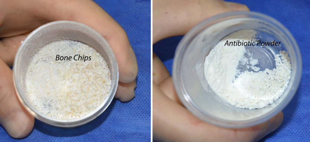 Bone Chip Filler Composite for Sliding Genioplasty Stepoff Dr Barry ...