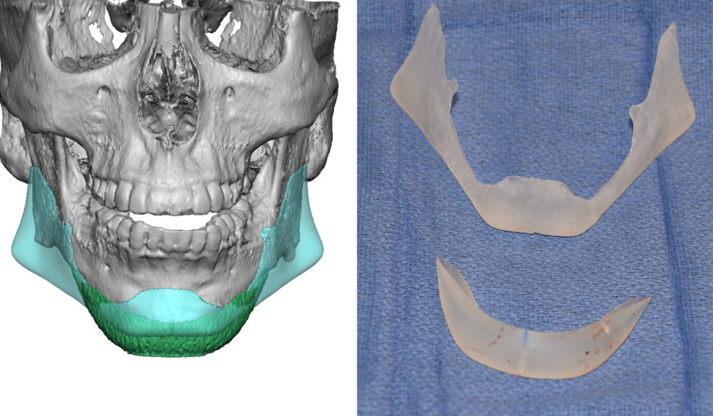 Plastic Surgery Case Study - Custom Jawline Implant Replacement in the ...