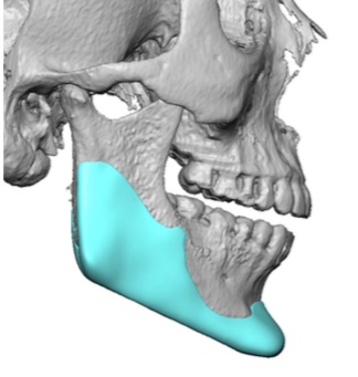 Custom Jawline Implant for the High Jaw Angle Patient design side view ...