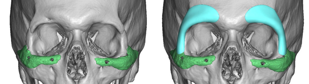 Plastic Surgery Case Study - Custom Lateral Brow Bone Implants for ...