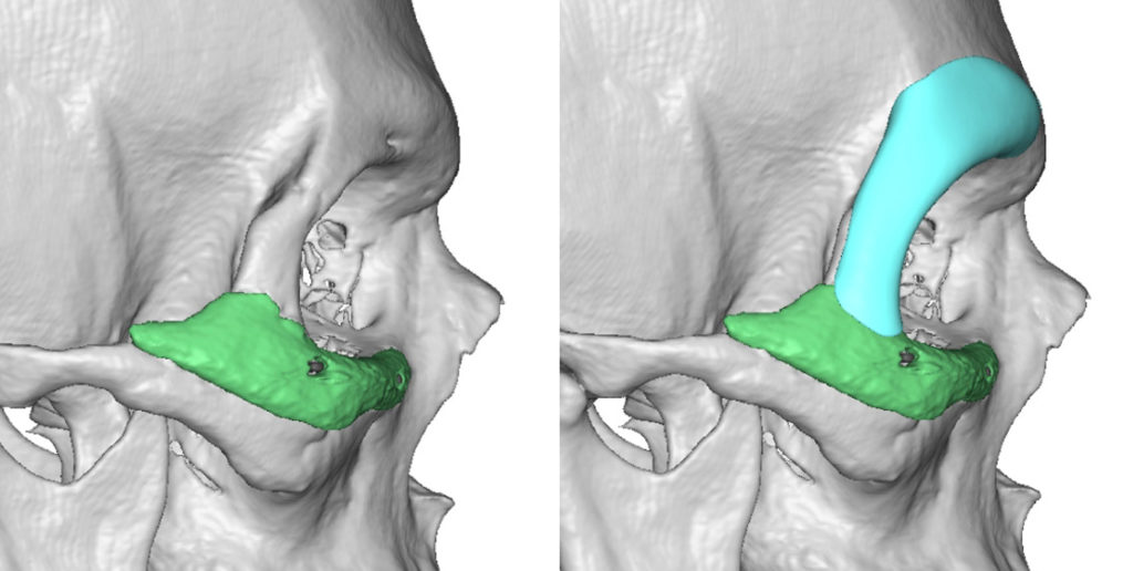 Plastic Surgery Case Study - Custom Lateral Brow Bone Implants for ...
