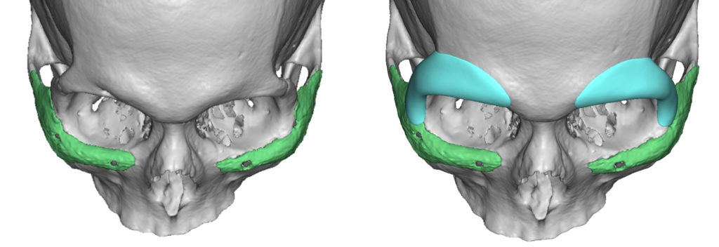 Plastic Surgery Case Study - Custom Lateral Brow Bone Implants for ...