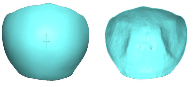 Plastic Surgery Case Study - Custom Skull Implant for Coverage of ...