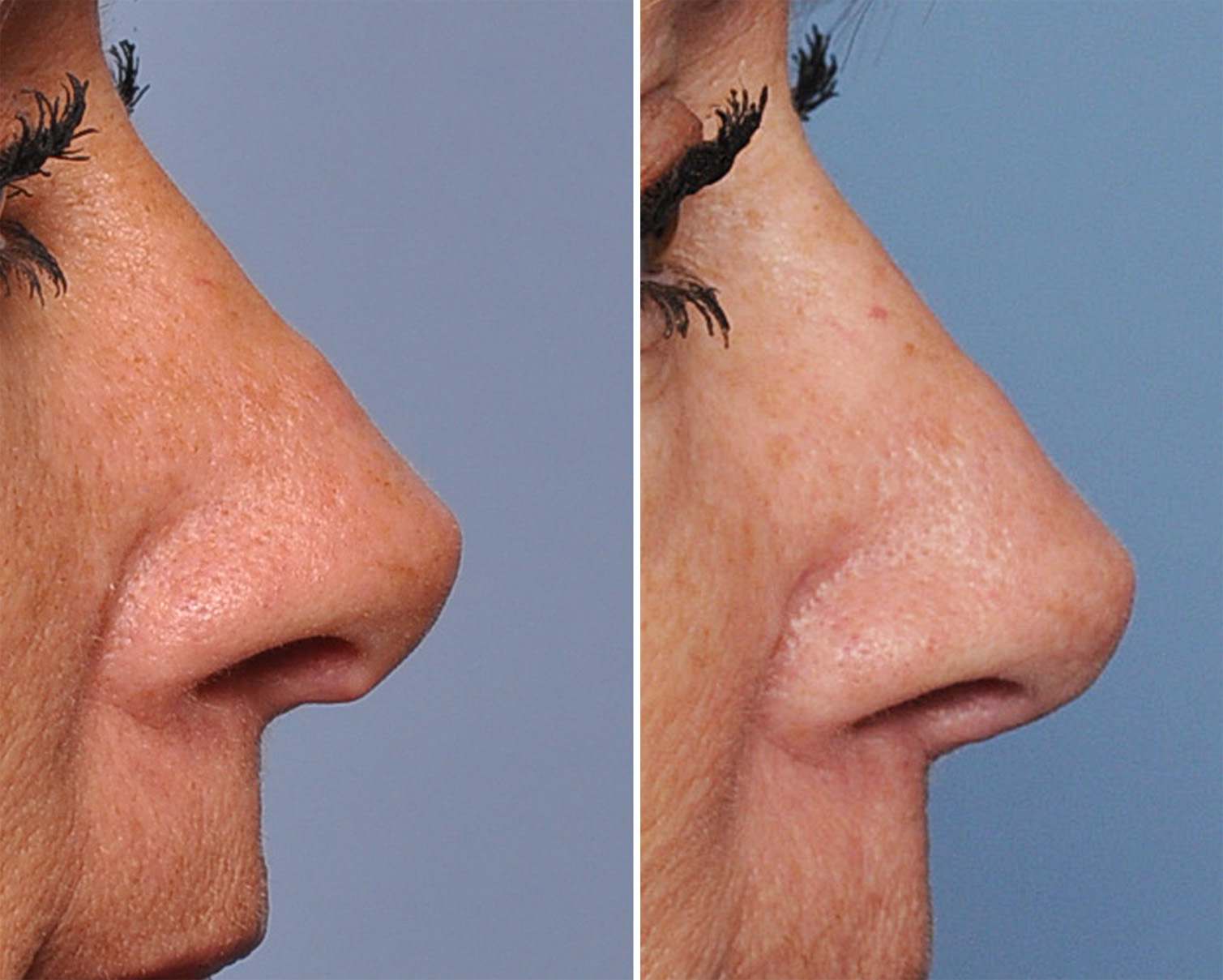 Understanding the Fate of Your Columella Post-Rhinoplasty | Justinboey