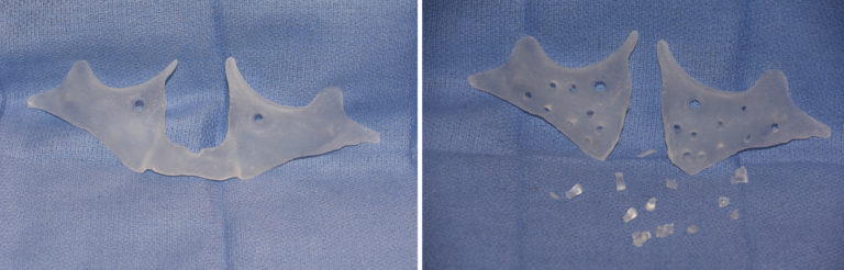 MIdface Implant with perfusion holes intraop Dr Barry Eppley ...