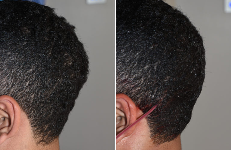 Plastic Surgery Case Study - Occipital Skull Reduction of Central Bony ...