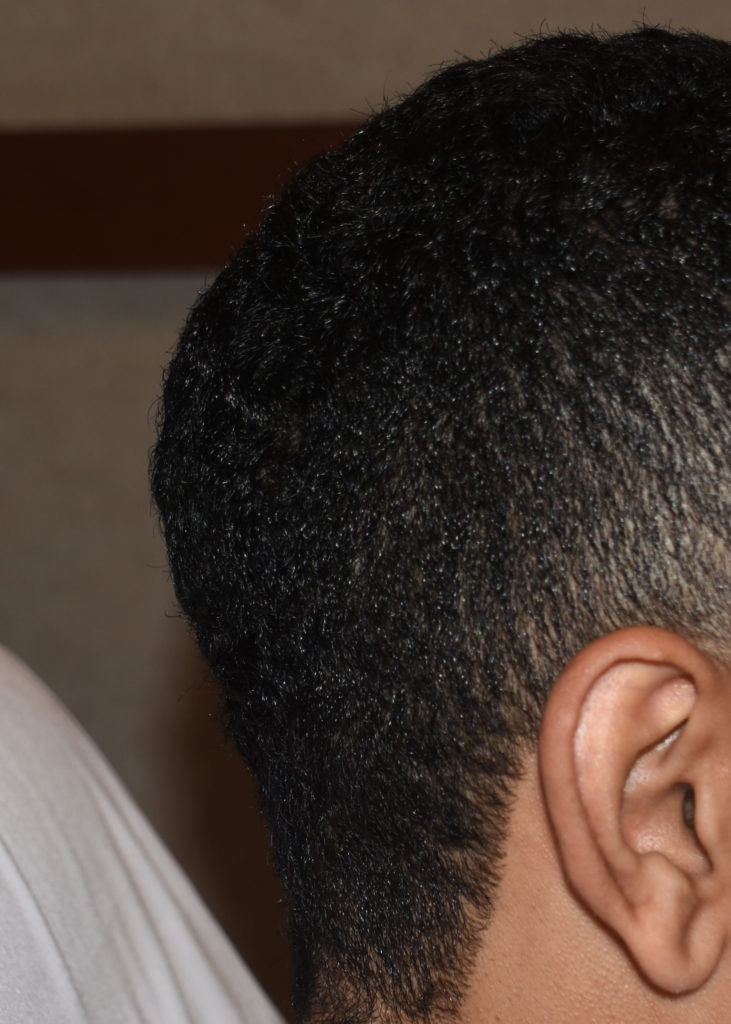 Male Occiptal Skull Protrusion side view Dr Barry Eppley Indianapolis ...