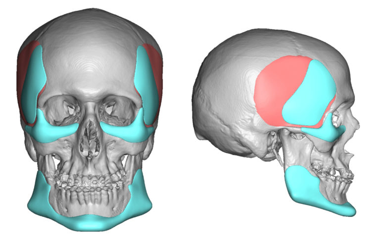 Plastic Surgery Case Study - Remove and Replace Custom Temporal ...