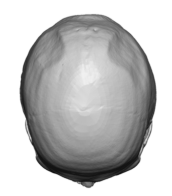 Parietal Skull Indentations 3D CT scan top view Dr Barry Eppley ...