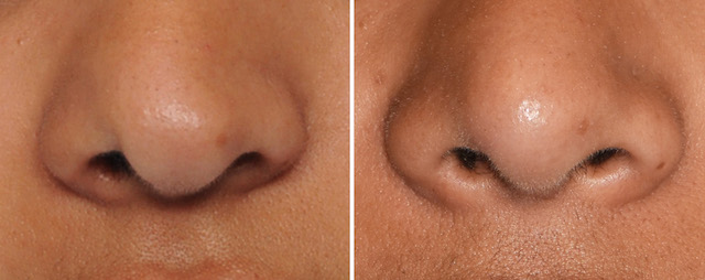 Alar-Columellar Deformities and Their Treatment in Rhinoplasty Surgery ...