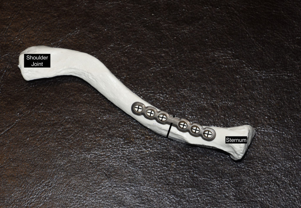 The Surgical Anatomy of the Clavicle in Shoulder Width Reduction ...