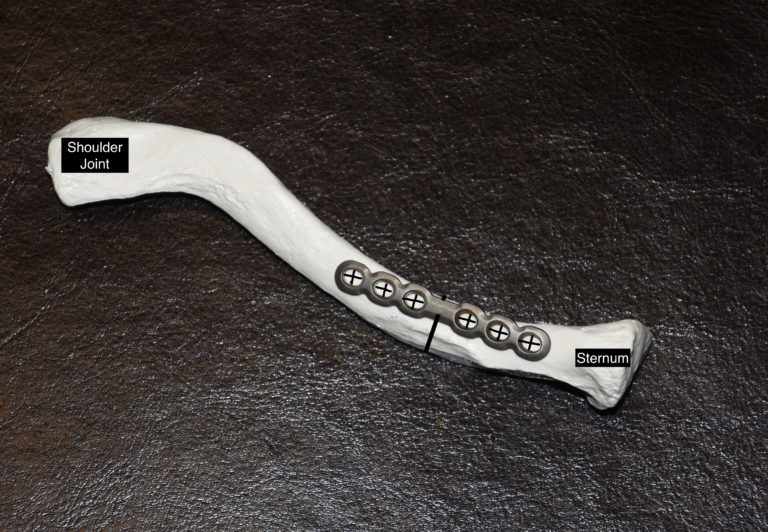 The Surgical Anatomy of the Clavicle in Shoulder Width Reduction ...