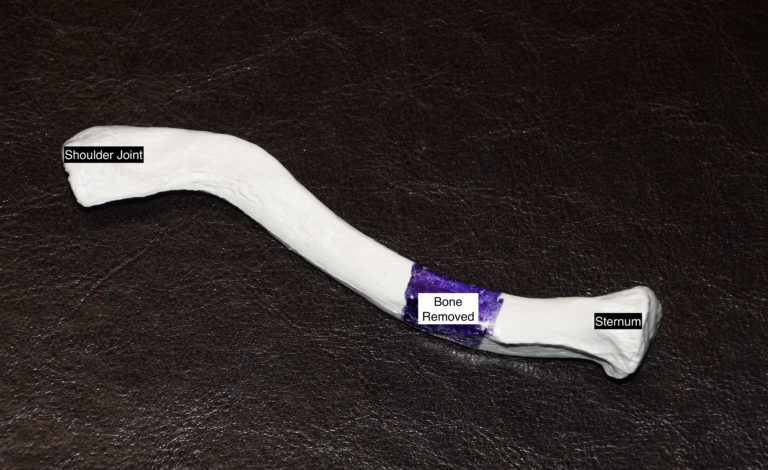 The Surgical Anatomy of the Clavicle in Shoulder Width Reduction ...