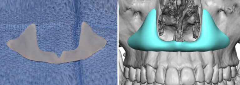 Plastic Surgery Case Study - Custom Premaxillary-Paranasal Implant ...