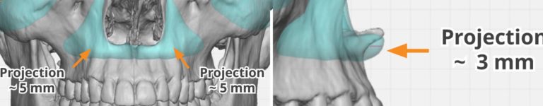 Plastic Surgery Case Study - Custom Premaxillary-Paranasal Implant ...
