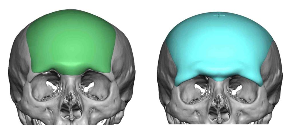 Plastic Surgery Case Study - Custom Forehead Implant Replacement with ...
