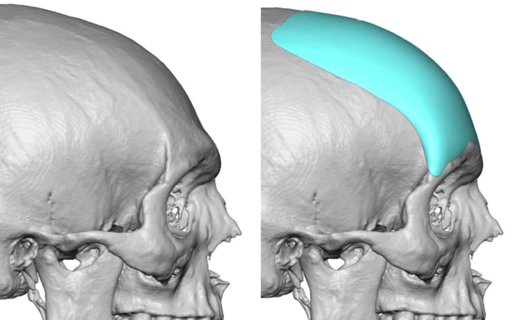 Plastic Surgery Case Study - Custom Forehead Implant for Correction of ...