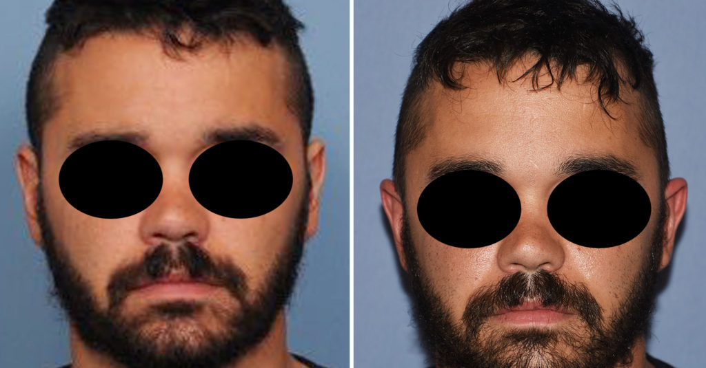 Postoperative Instructions for Temporal Reduction Surgery - Explore ...