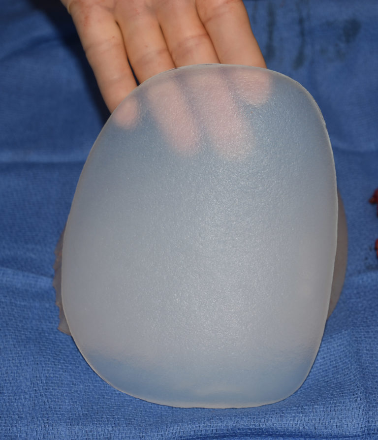 Plastic Surgery Case Study - Treatment of Pectoral Implant Contracture ...