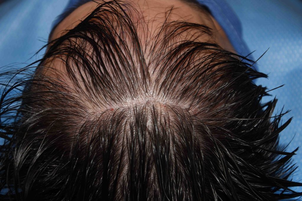Plastic Surgery Case Study - Custom Forehead Implant Replacement with ...