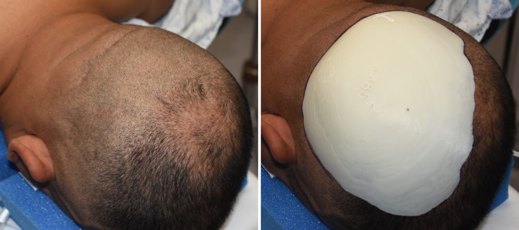 Plastic Surgery Case Study - Custom Occipital-Parietal Skull Implant in ...